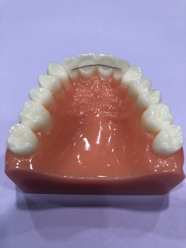 Retainer Options - Varallo Orthodontics